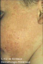La dermatite atopique (D.A.) : épidémiologie, aspects cliniques ...
