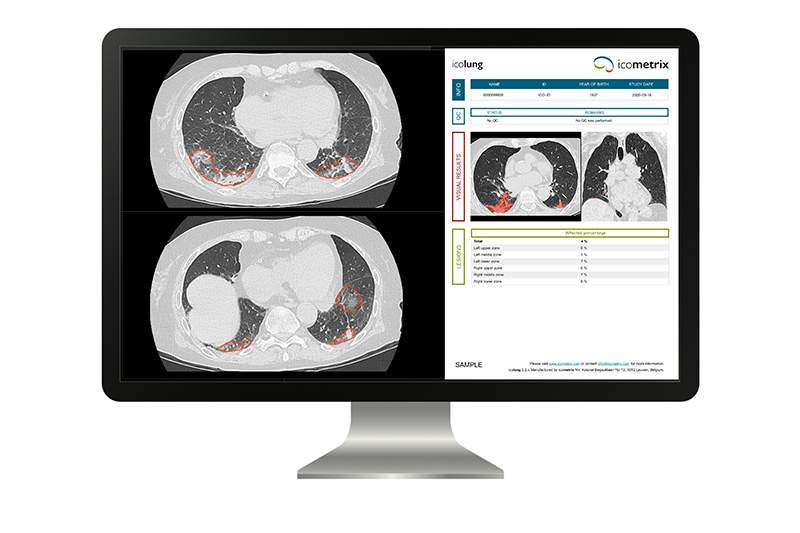 icometrix lance la première solution certifiée CE basée sur l'IA pour l ...