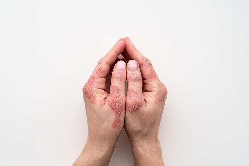 Psoriasis en plaques modéré à sévère : feu vert européen pour BIMZELX ...